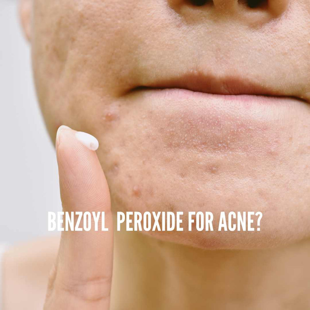Benzoyl Peroxide : How It Helps Acne But You Might Be Using It Wrong