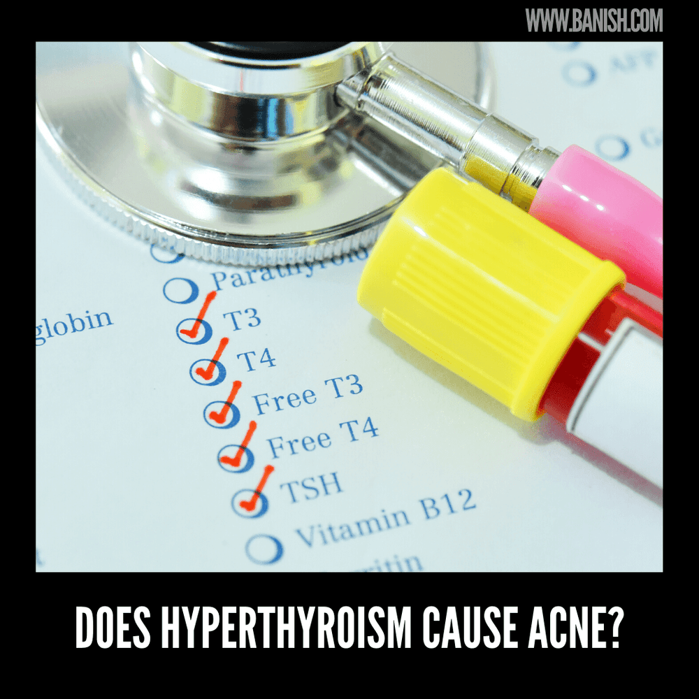 Does Hyperthyroidism Cause Acne?