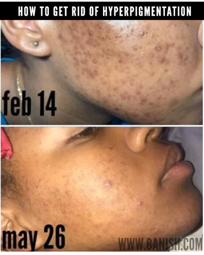 How To Get Rid Of Hyperpigmentation With Visible Results