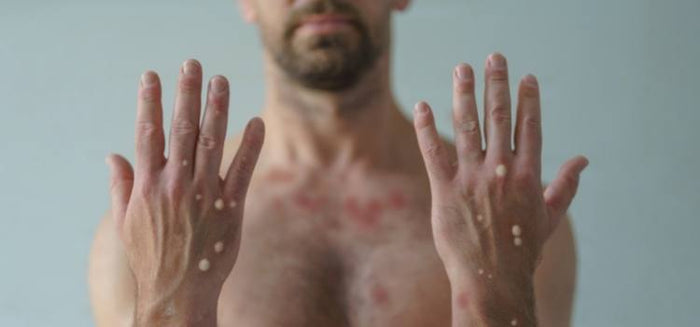 Scars From Monkeypox? Here's How To Take Care Of Your Skin After Monkeypox