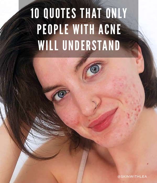 10 Relatable Acne Quotes That Hit Us Deep | Banish
