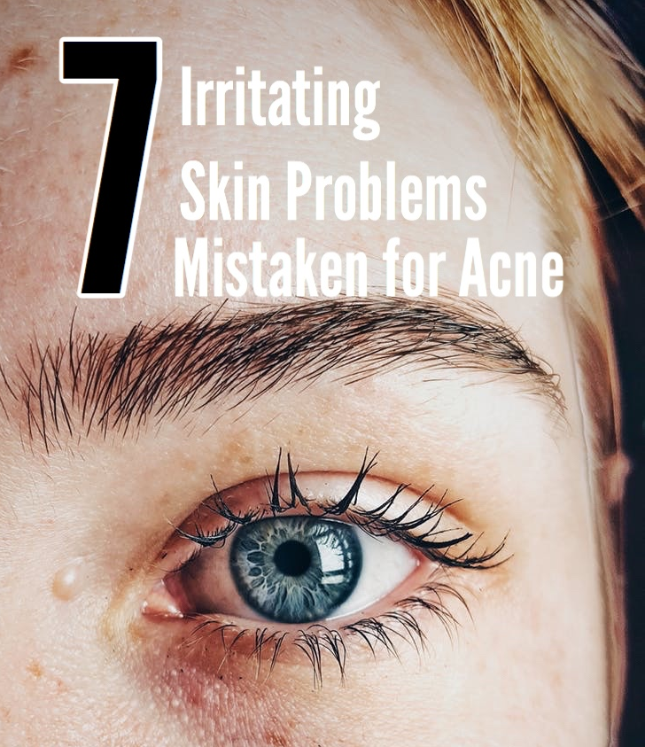 7 Irritating Skin Problems Mistaken for Acne