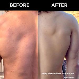 Bacne Blaster - AHA Body Scrub For Back Acne, Keratosis Pilaris - Organic