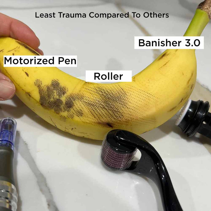 Banish Kit 3.0: Safest Home Microneedling Tool for Acne Scars - up to ...