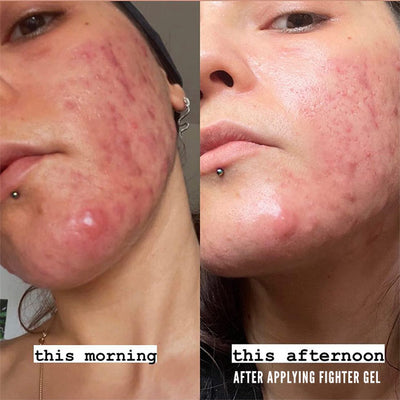 Fighter Gel - Fights Eczema, Dry Skin, Redness & Acne