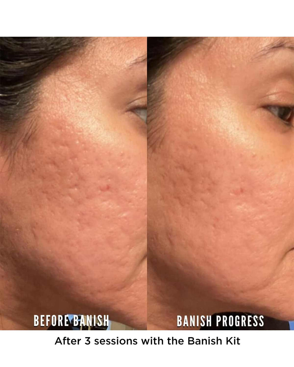 Skincare - Buy Banish Skincare | Natural Products For Acne Scars