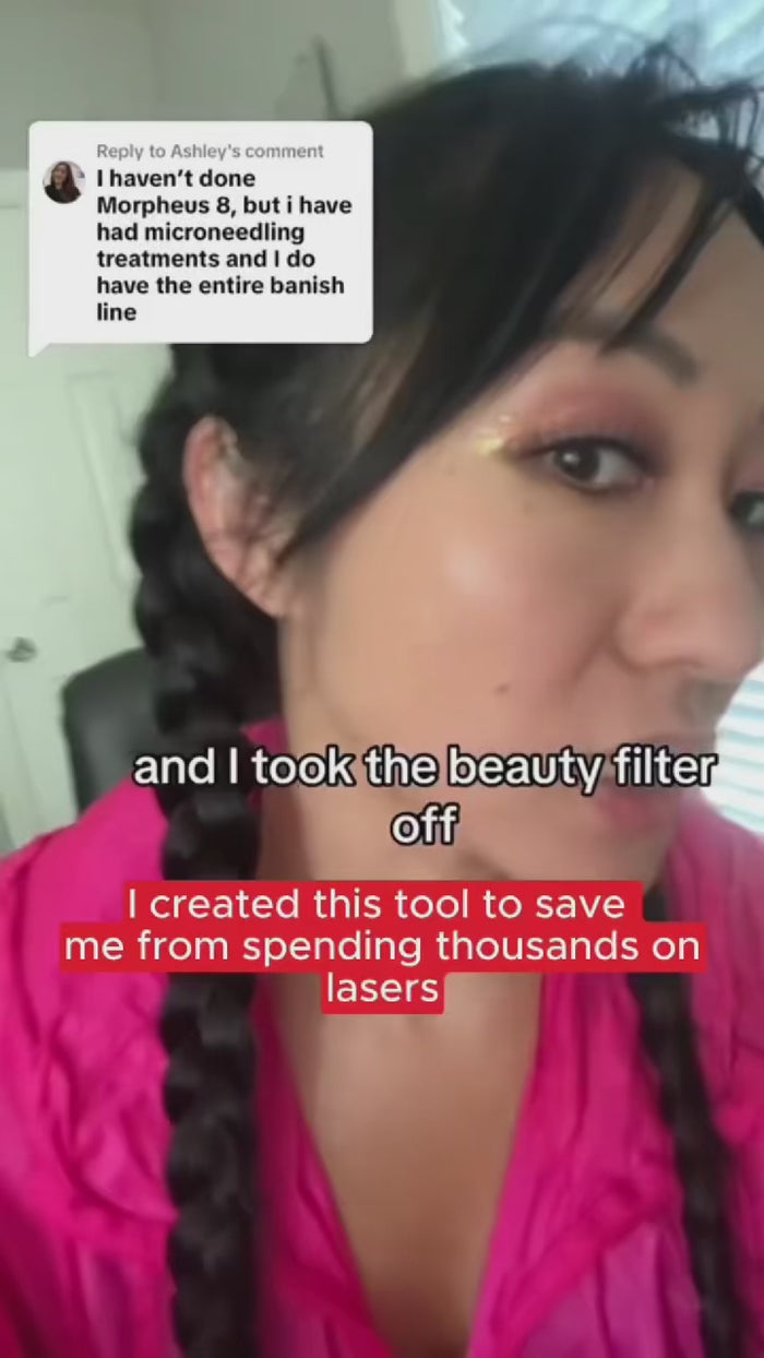 Banish Kit 3.0: Safest Home Microneedling Tool for Acne Scars - up to ...