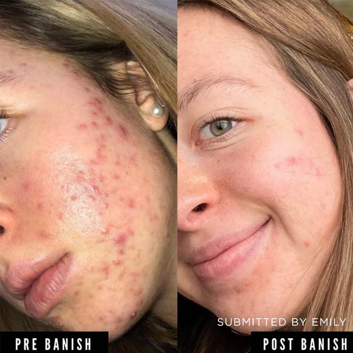 Banish Starter Kit - Skincare with Home Microneedling To Improve Skin ...